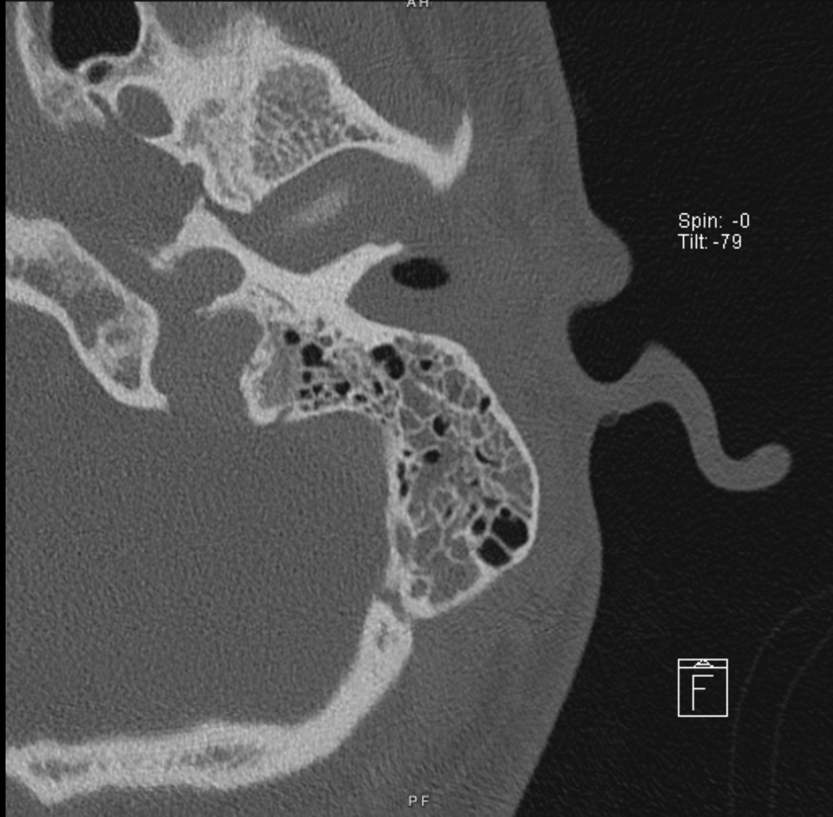 AN UNUSUAL CASE OF MASTOIDITIS IN AN UNVACCINATED PATIENT - SHM ...