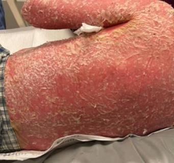 BENEATH THE SURFACE: A CASE OF BACTRIM-TRIGGERED ERYTHRODERMIC ...