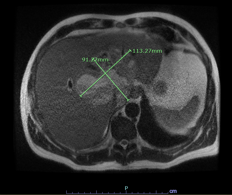 PYOGENIC LIVER ABSCESS MASQUERADING AS A HEPATIC TUMOR - SHM Abstracts ...