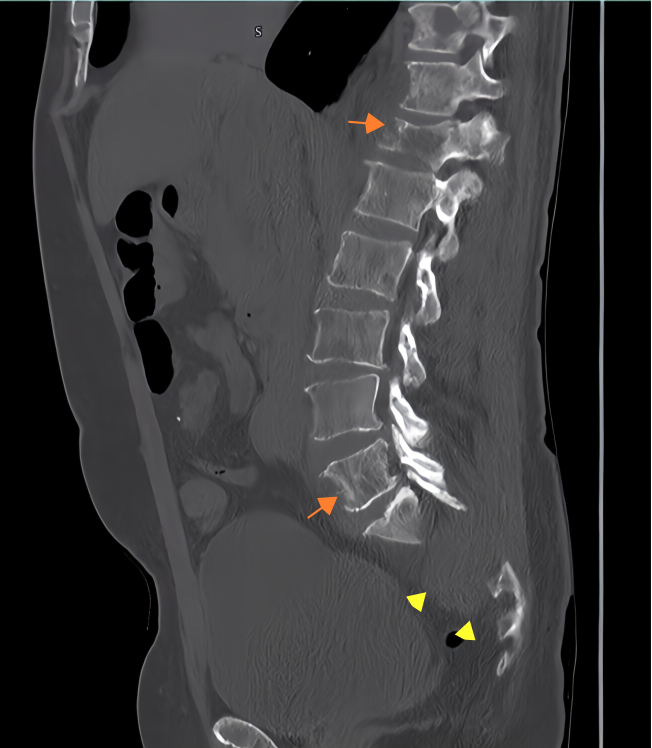 UNUSUAL CASE OF PLASMA CELL NEOPLASM MASQUERADING AS A SACRAL MASS IN A ...