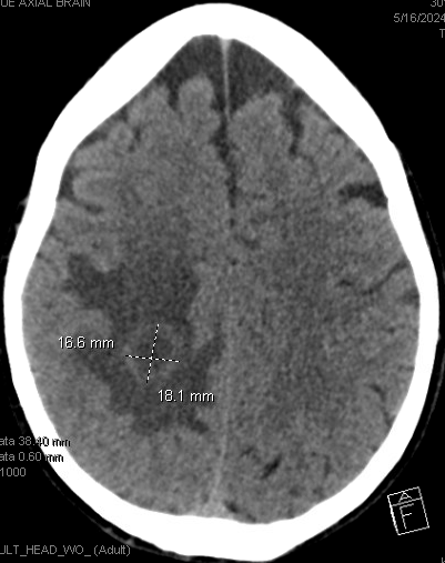 BLACK MOLD IN THE BRAIN: A CASE OF CLADOPHIALOPHORA BANTIANA CEREBRAL ...