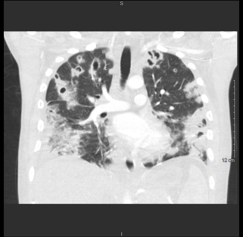 CAVITARY PULMONARY LESIONS; A MANIFESTATION OF RIGHT-SIDED INFECTIVE ...