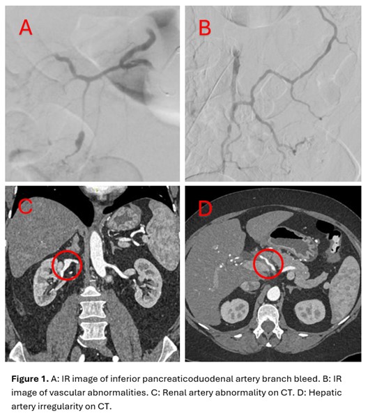 LOEYS-DIETZ SYNDROME PRESENTING AS ACUTE RETROPERITONEAL BLEED - SHM ...