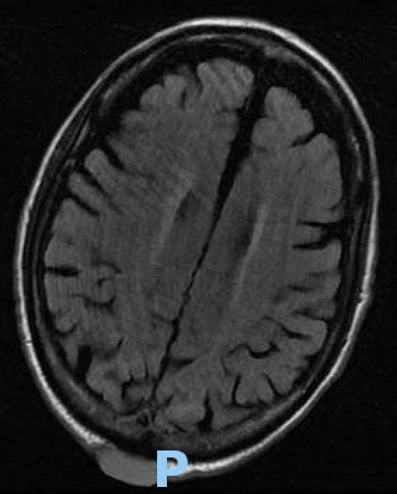 SCALP LESION AND DIPLOPIA AS THE INITIAL PRESENTATION OF METASTATIC ...