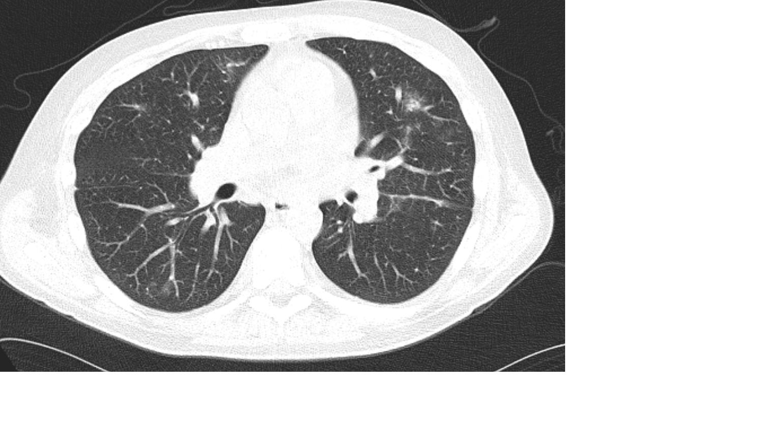 AH! PJP: PNEUMOCYSTIS PNEUMONIA IN AN HIV NEGATIVE PATIENT WITH ...