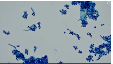 BREAKING THE MOLD: WHEN BACK PAIN REVEALS A TUBERCULOUS SURPRISE - SHM ...