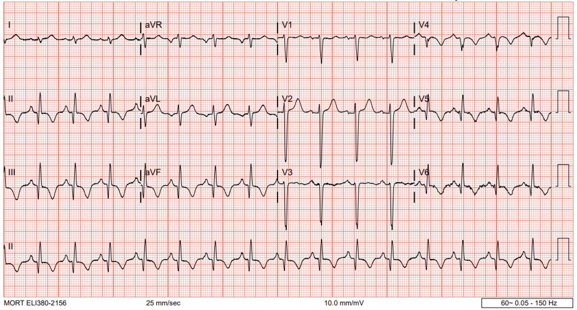 DOUBLE JEOPARDY: NSTEMI AND STROKE UNMASKING POLYCYTHEMIA VERA - SHM ...