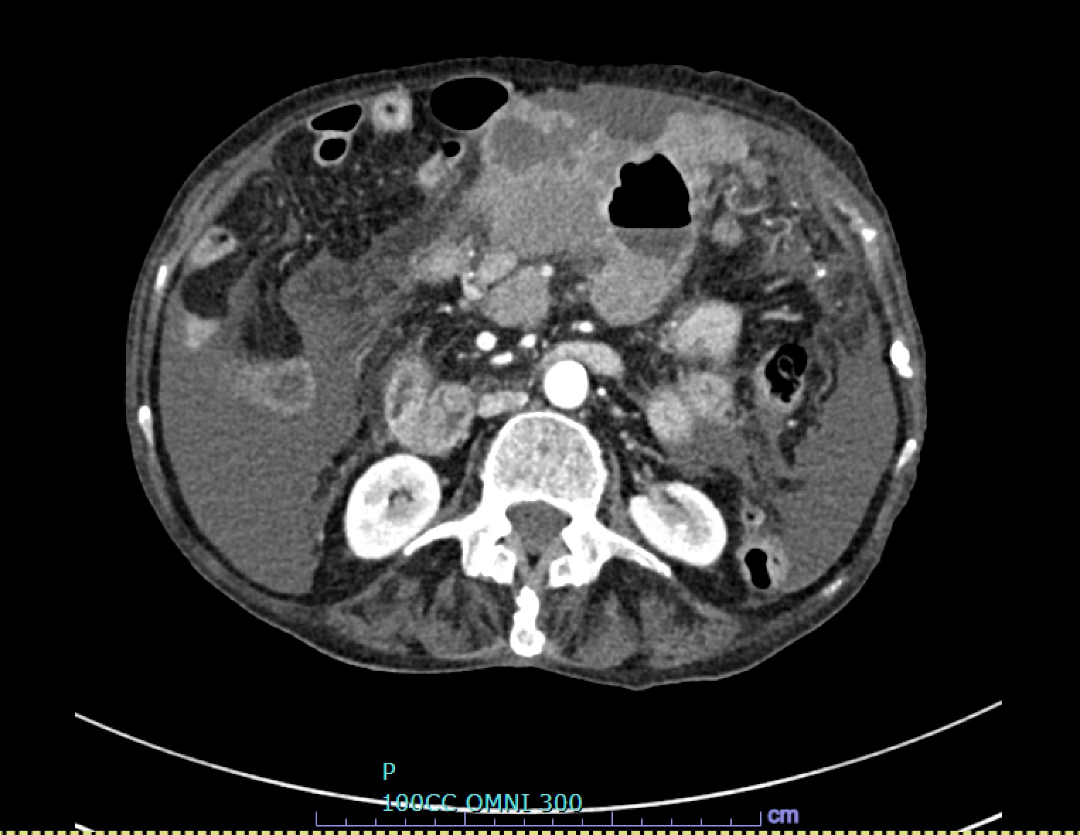 THROUGH THE OWL'S EYES: CYTOMEGALOVIRUS GASTRITIS IMITATING GASTRIC ...