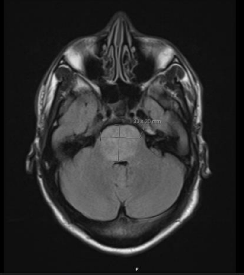 POSTERIOR REVERSIBLE ENCEPHALOPATHY SYNDROME ,BRAINSTEM AND CKD : A ...