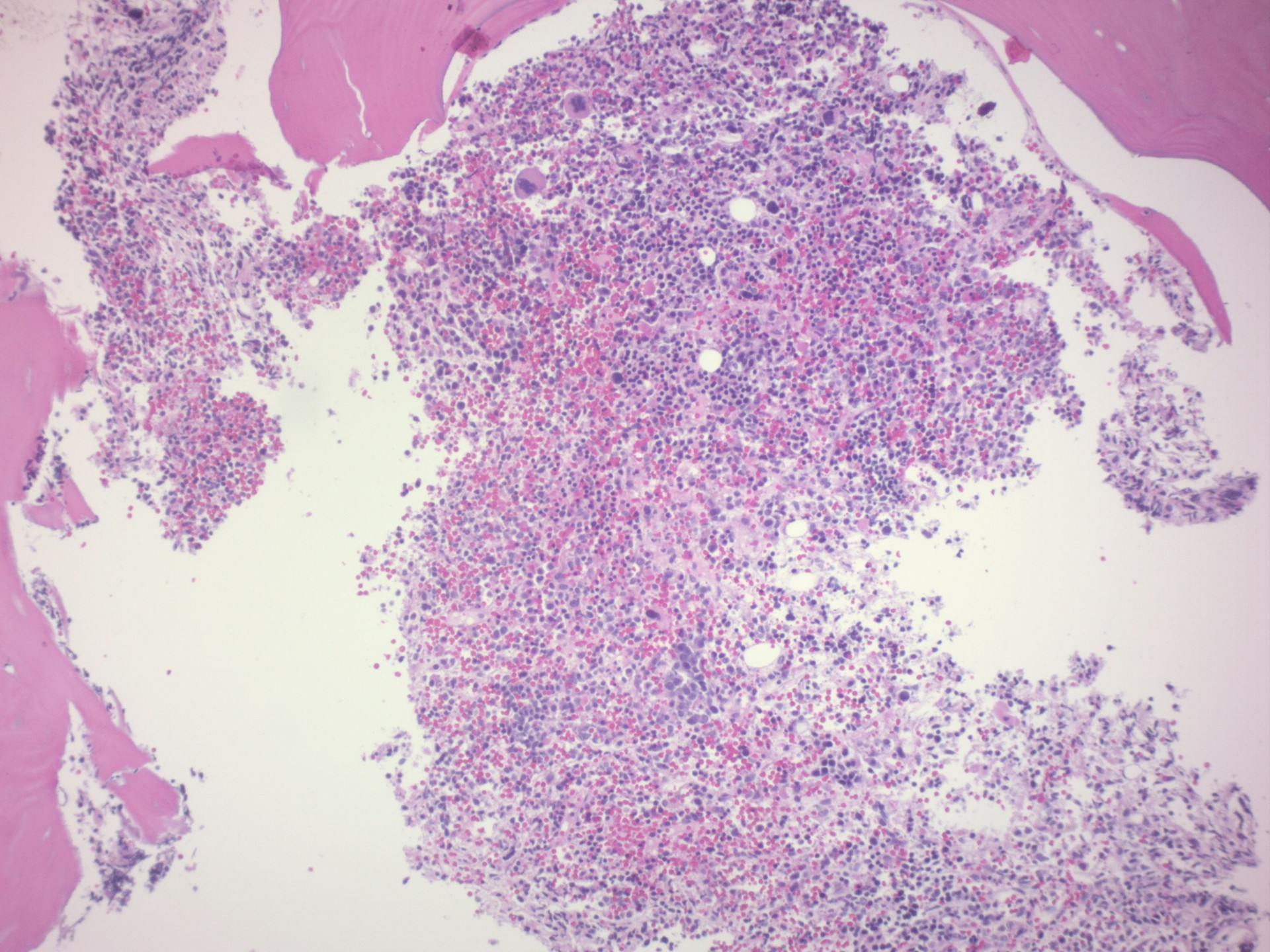 FROM BLOODY STOOL TO BLOOD CANCER; AN ACUTE DIAGNOSIS OF AML PRESENTING ...