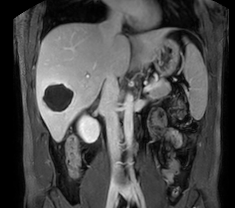 UNRAVELING THE RECURRENCE OF AMEBIC LIVER ABSCESS - SHM Abstracts ...