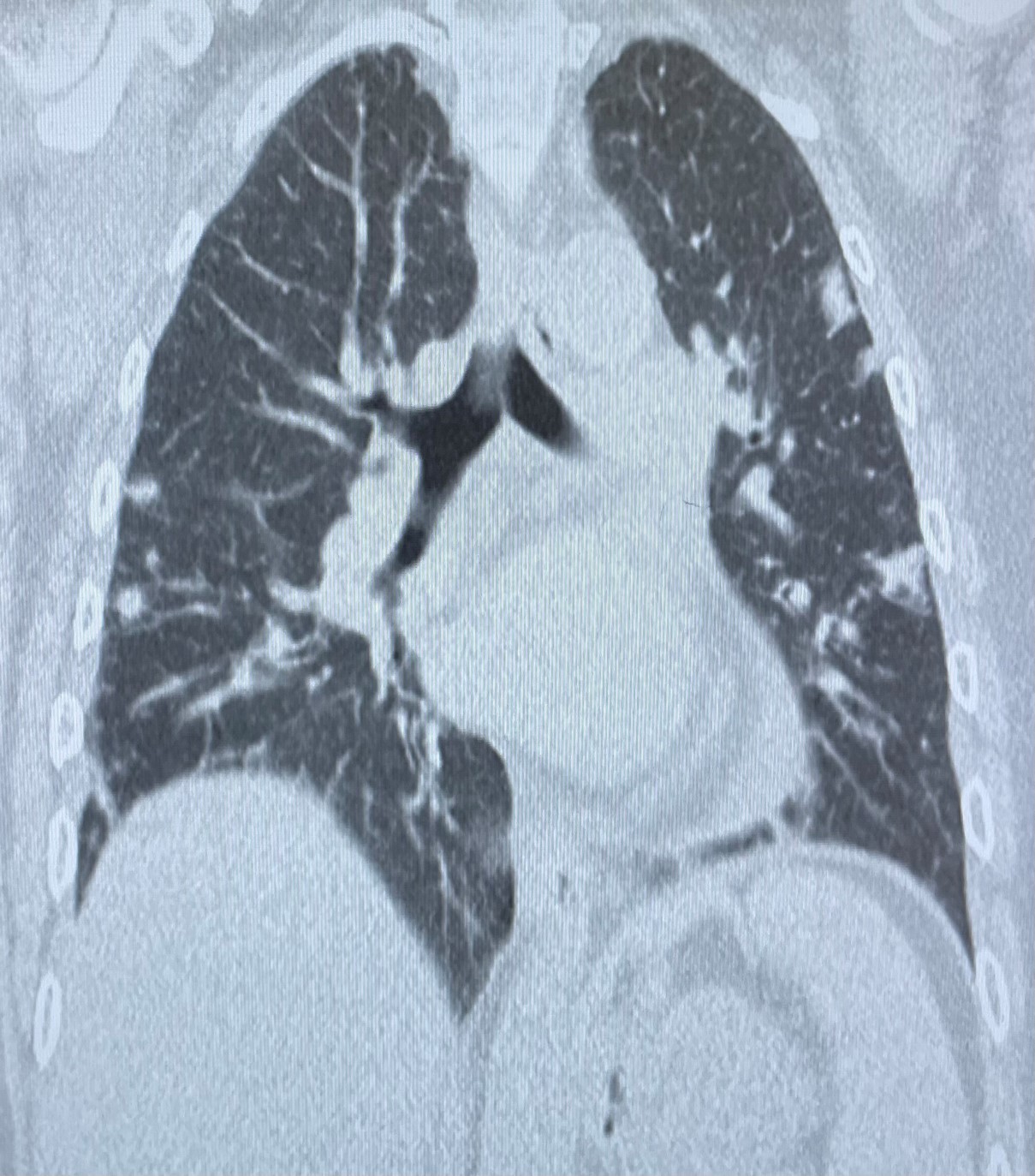 RIGHT ATRIAL EMBRYONIC REMNANTS: INFECTIOUS ENDOCARDITIS IN A PATIENT ...